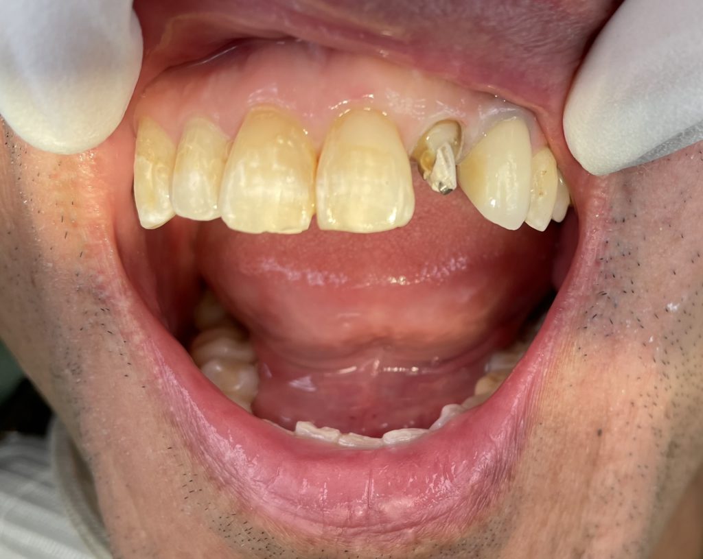 True Face of PFM Crown – 101 Dental